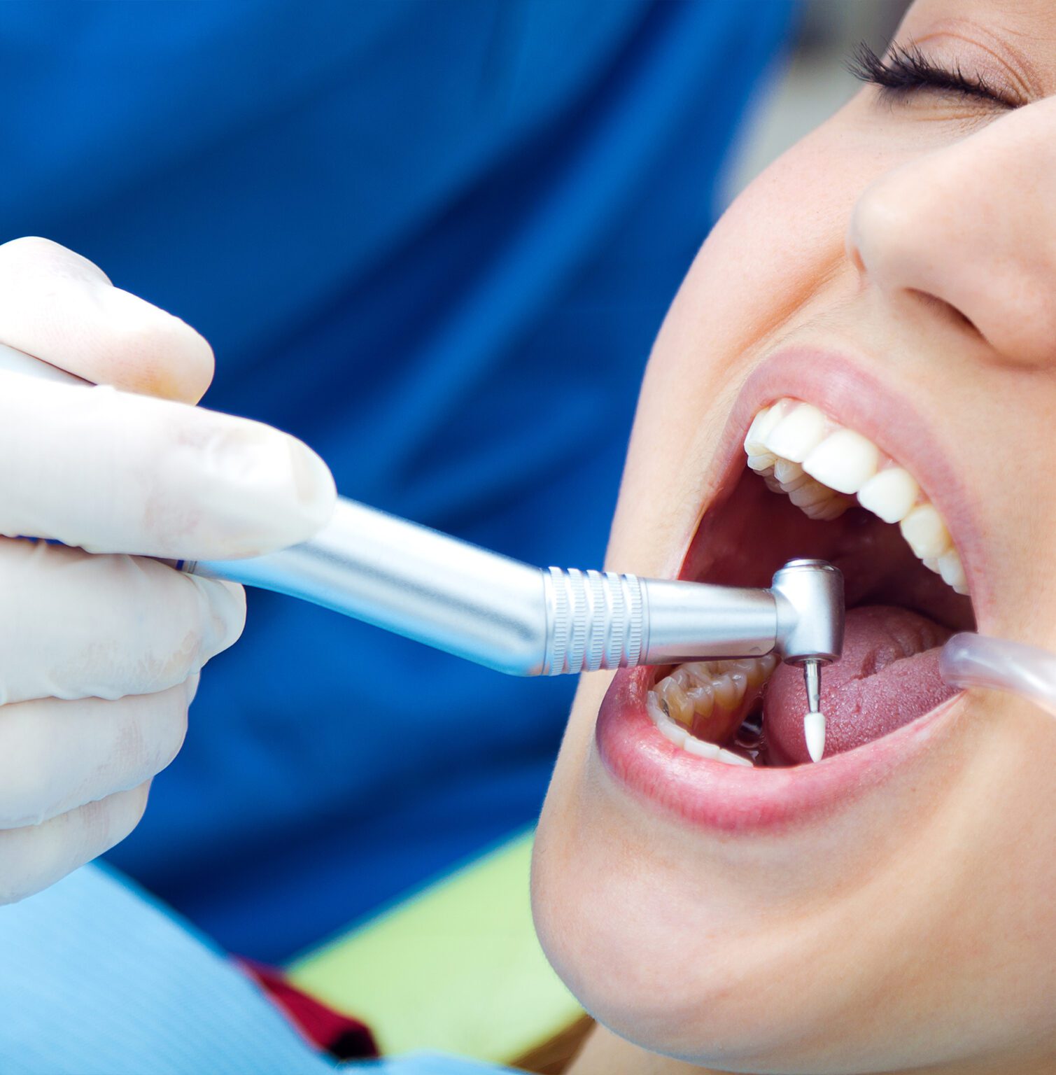 Teeth Scaling – The White Dental Expert
